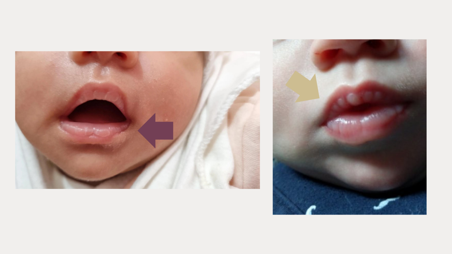 What You Need To Know About Suck Blisters - Arkansas Lactation
